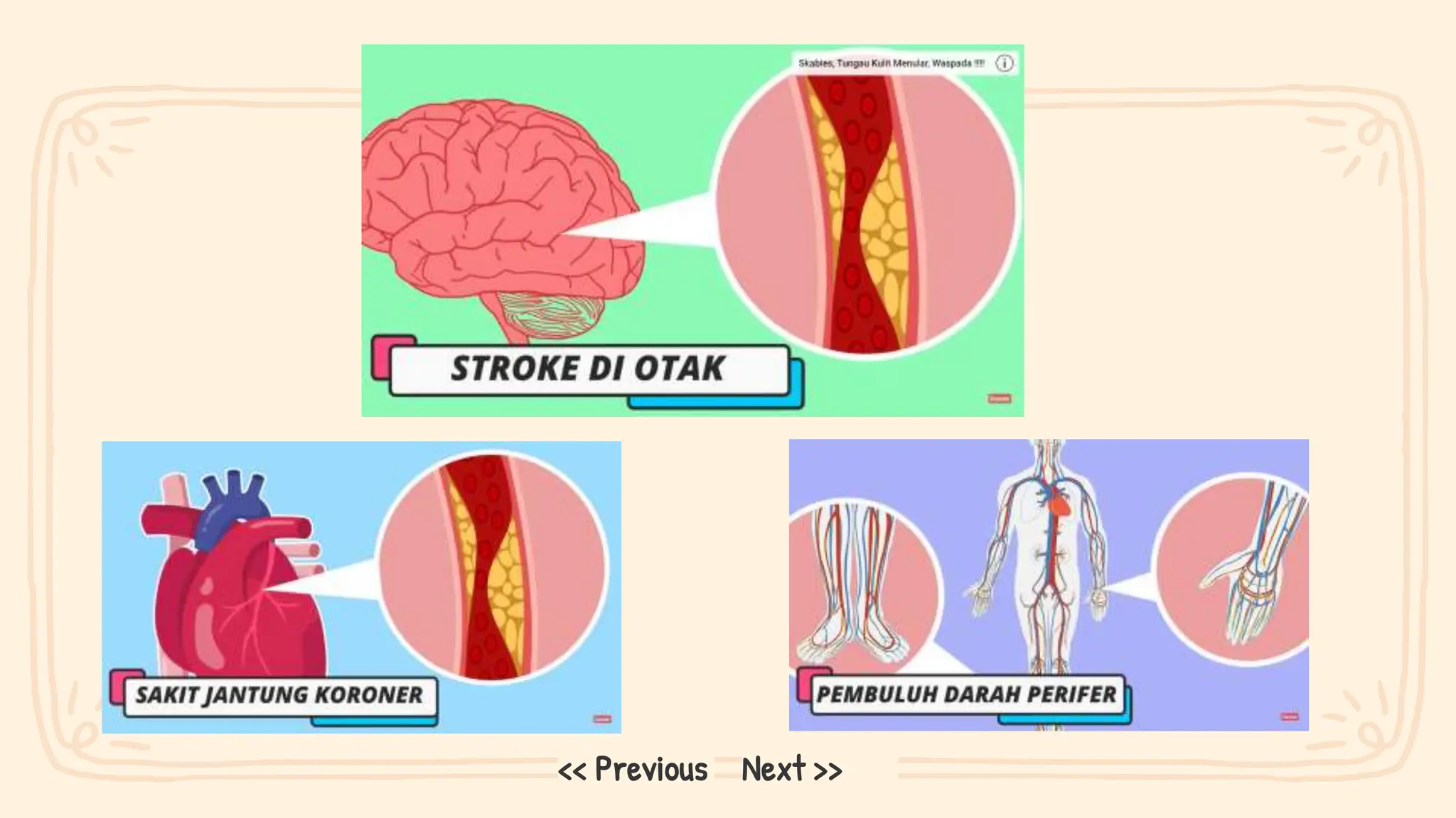 Hiperkolestrol dan cara pencegahannya.pptx