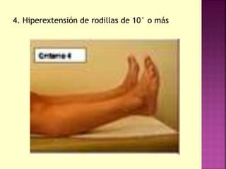 hiperlaxitud.pptx