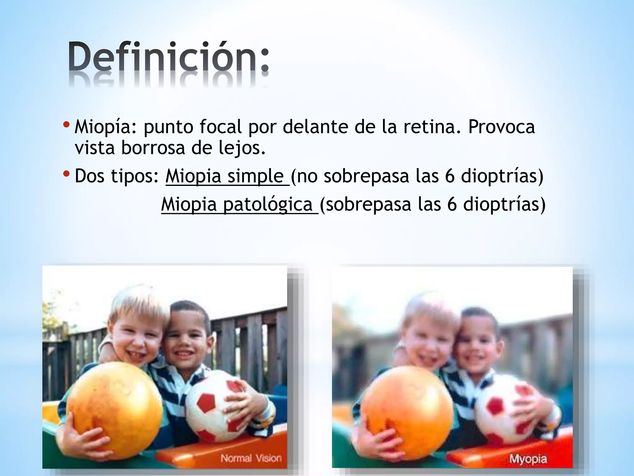 Hipermetropia y miopia. | PPT