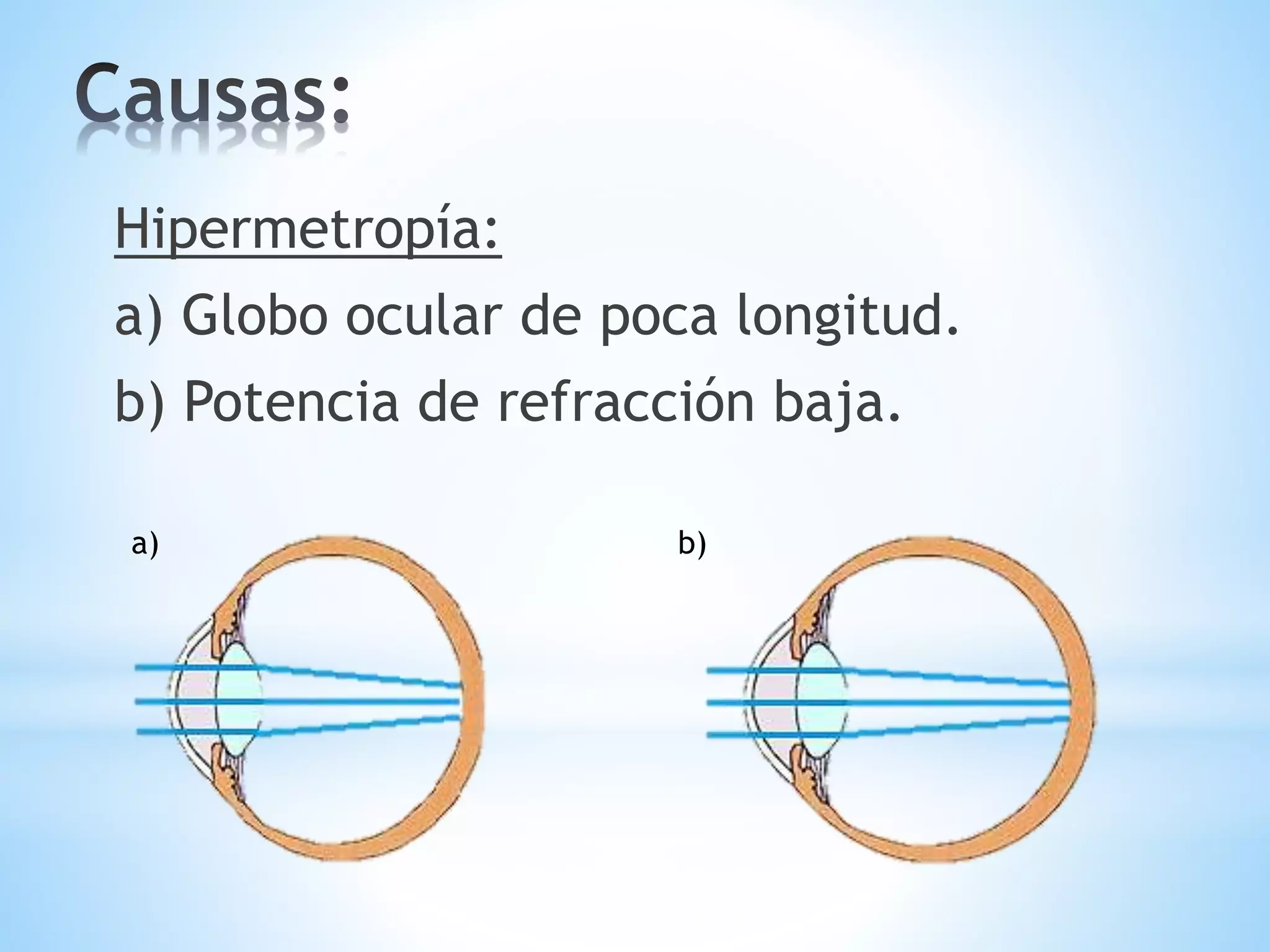 Hipermetropia y miopia. | PPTX