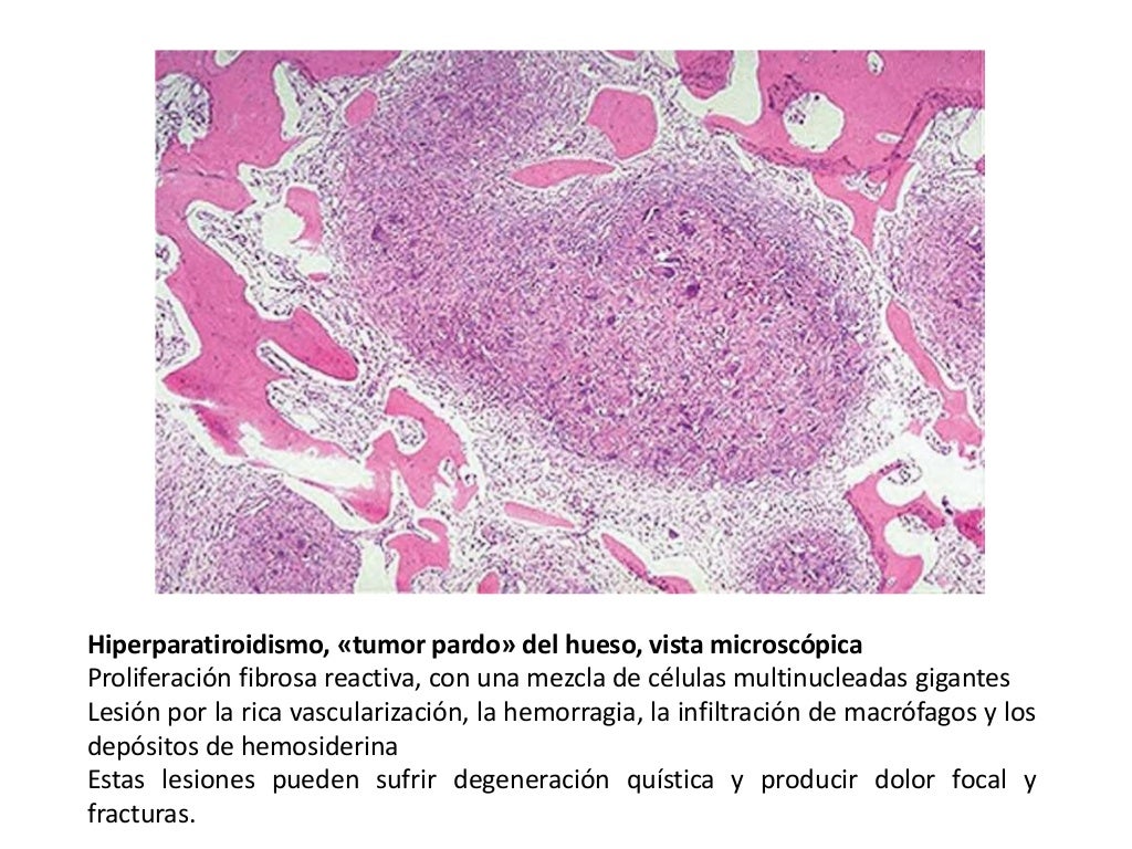 Hiperparatiroidismo