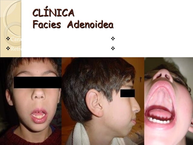 Hiperplasia Benigna De La Adenoides Y De Las Amigdalas Fmh Unprg ...