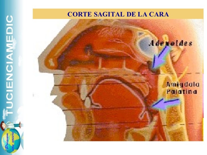 Hiperplasia Benigna De La Adenoides Y De Las Amigdalas Fmh Unprg Tuc…