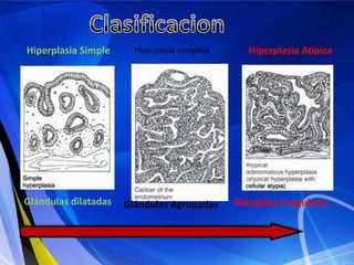 Hiperplasia endometrial (2) | PPTX