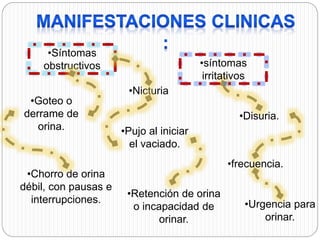 Hiperplasia prostática benigna | PPTX