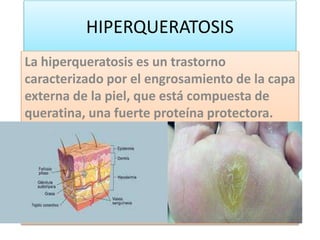 HIPERQUERATOSIS 1.pptx