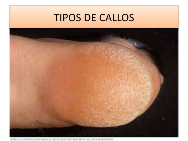 HIPERQUERATOSIS 1.pptx