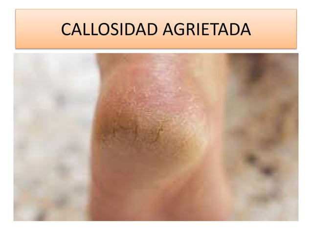 HIPERQUERATOSIS 1.pptx