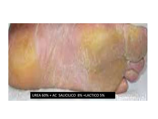 HIPERQUERATOSIS 1.pptx