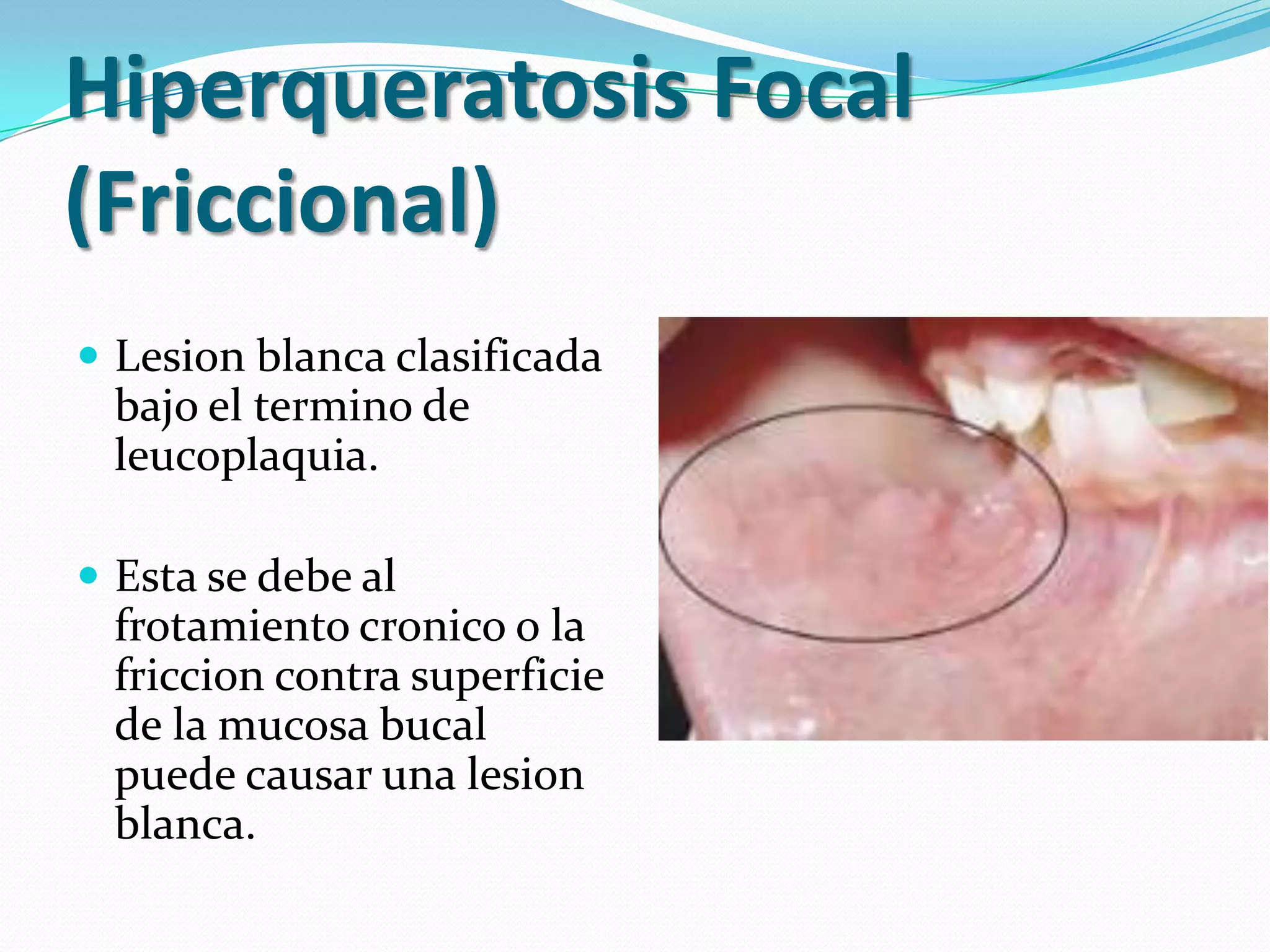 Hiperqueratosis focal (friccional) | PPTX