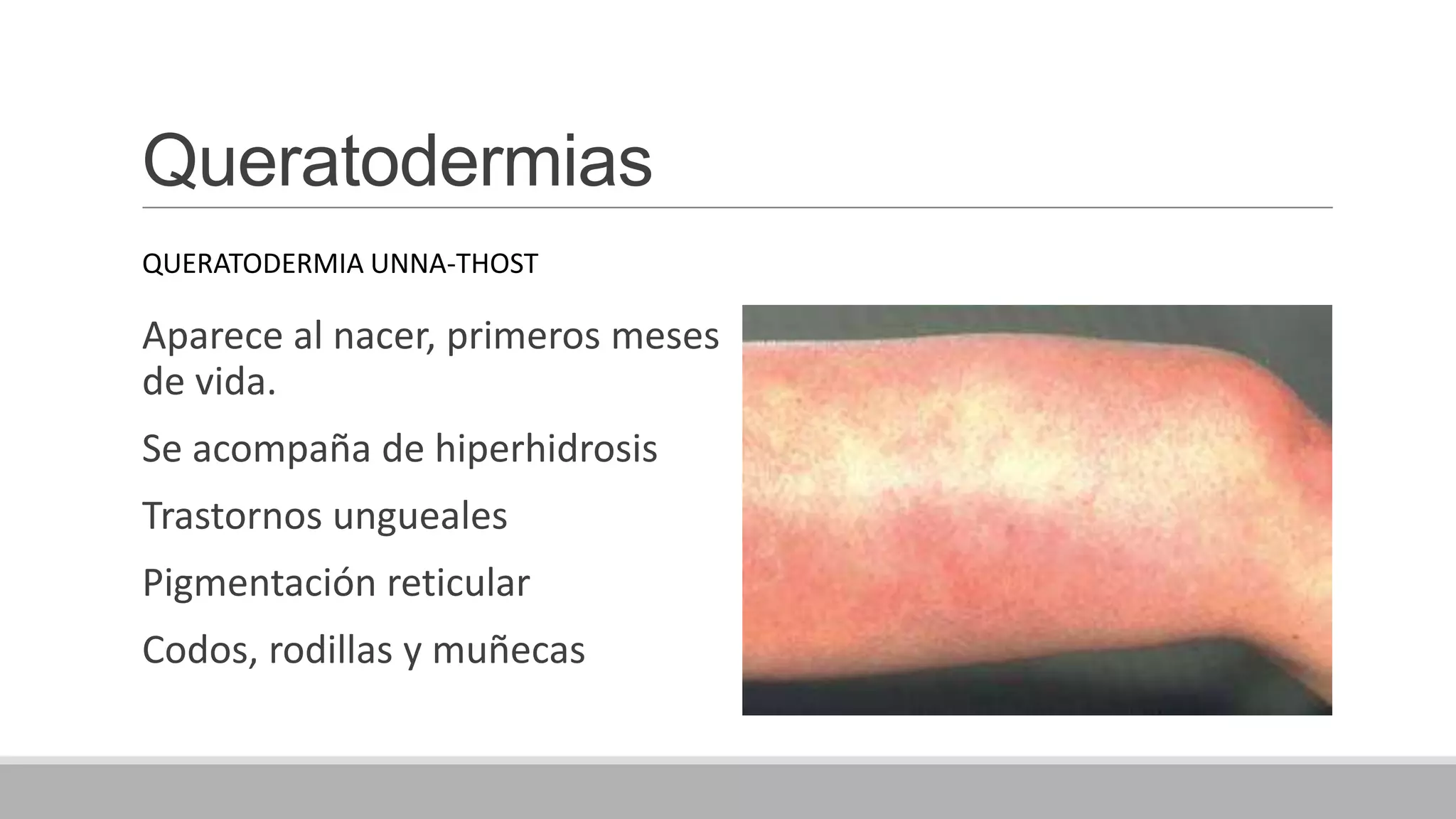 Hiperqueratosis palmoplantar | PPT