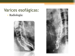 Hipertensión portal: Várices esofágicas y encefalopatía. | PPTX