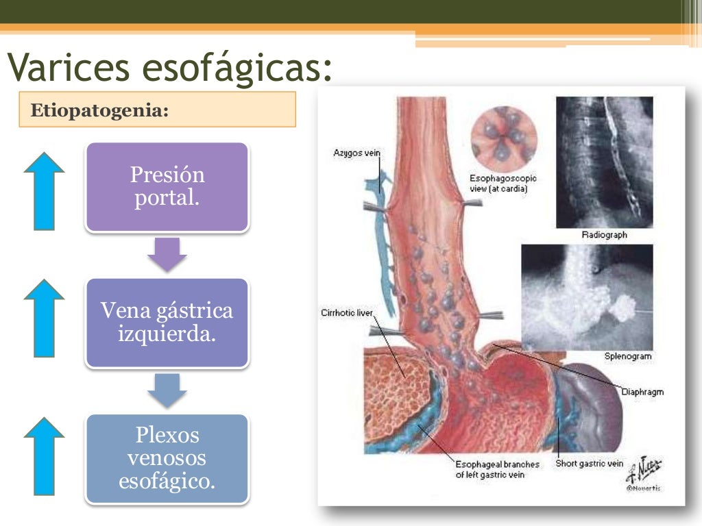 Hipertensión portal: Várices esofágicas y encefalopatía.