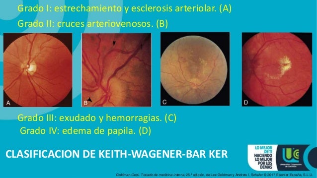 Hipertension arterial