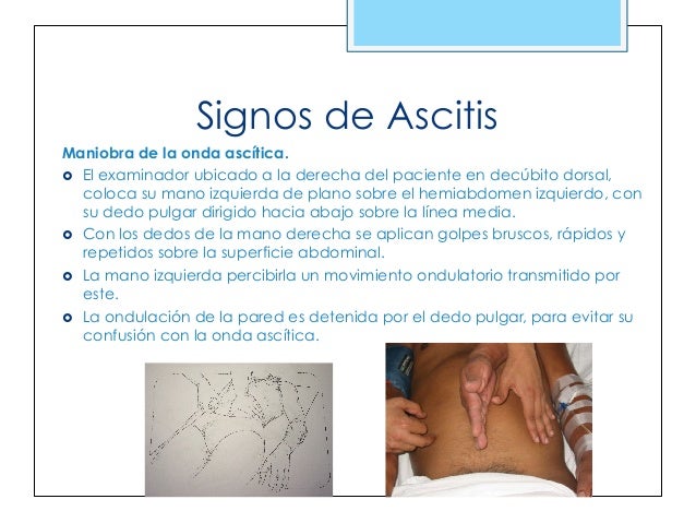 Hipertensión portal y ascitis