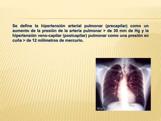 Hipertension pulmonar | PPTX