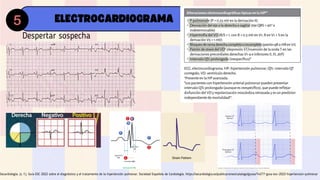HIPERTENSION PULMONAR .123455678 (1).pdf
