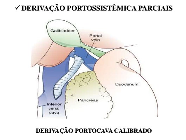 Hipertensão Portal