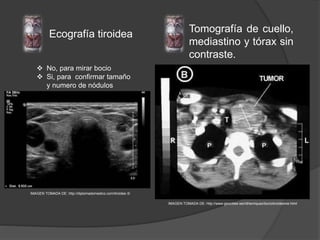 Hipertiroidismo- semiologia | PPTX