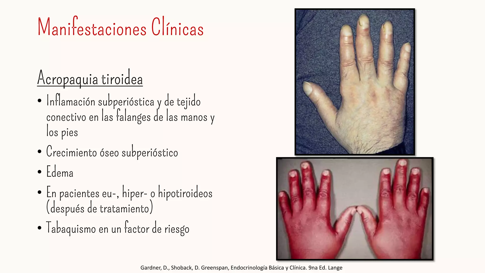 Hipertiroidismo: Enfermedad de Graves | PDF