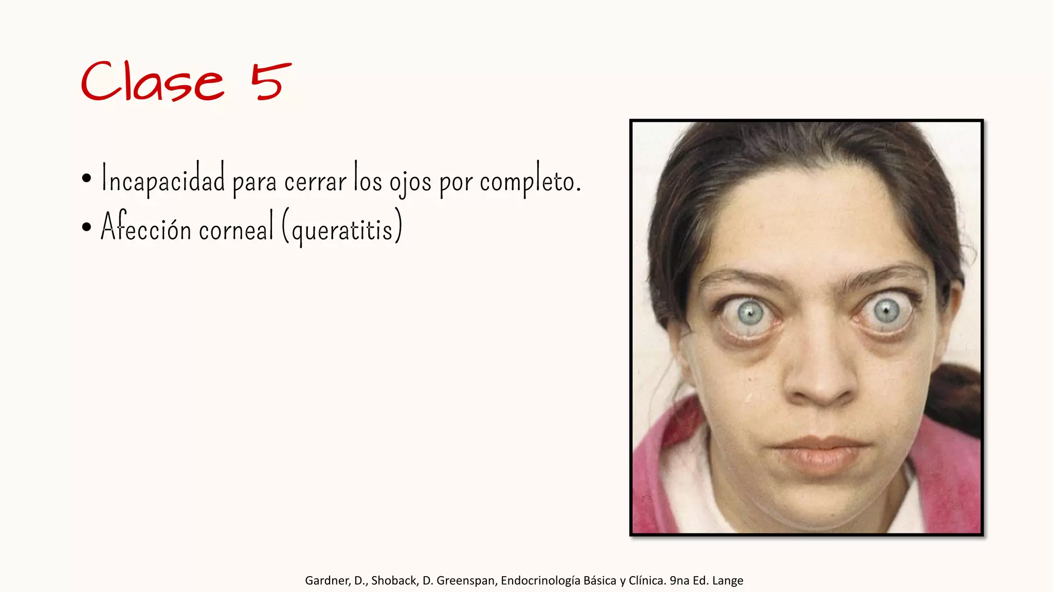 Hipertiroidismo: Enfermedad de Graves | PDF