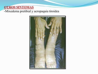 Hipertiroidismo | PPTX