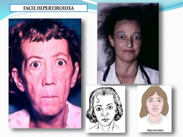 Hipertiroidismo