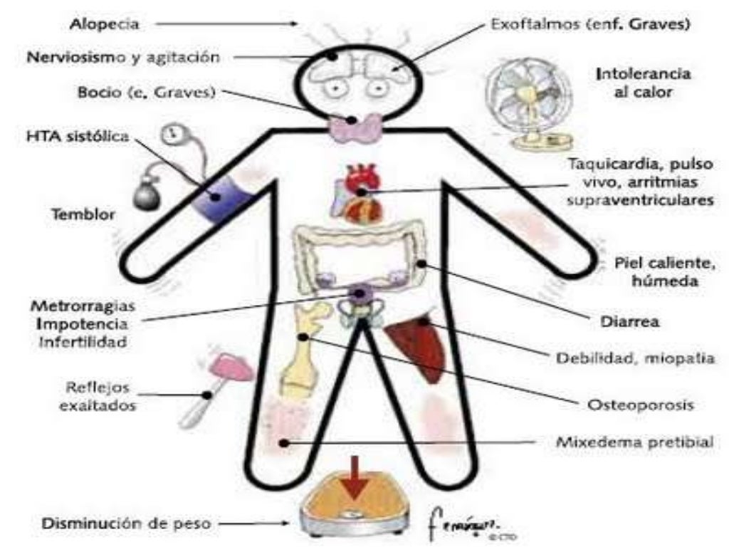 Hipertiroidismo(2) (1)