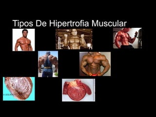 Hipertrofia | PPTX
