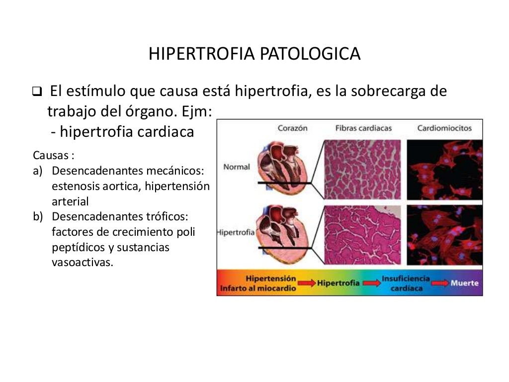 Hipertrofia