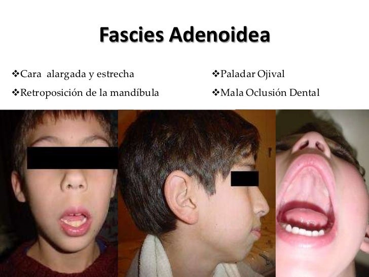 Hipertrofia Adenoidea - SOAS