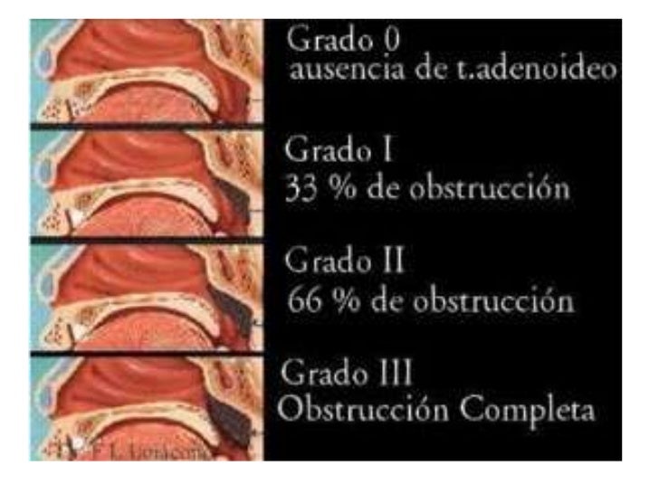 HIPERTROFIA ADENOIDEA PDF