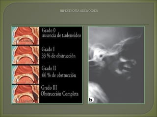 Radiografía De Adenoides