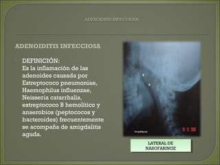 Radiografía De Adenoides