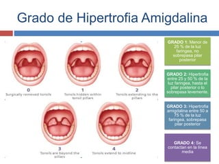 Hipertrofia de adenoides | PPTX