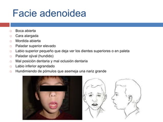 Hipertrofia de adenoides | PPTX