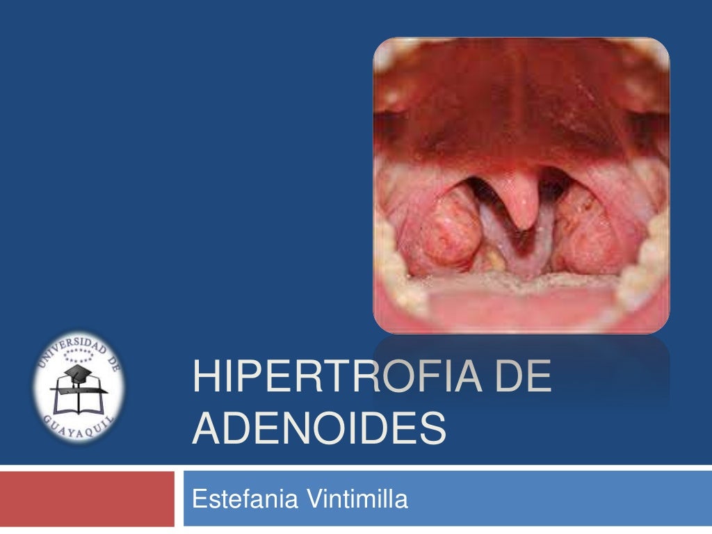 Hipertrofia de adenoides
