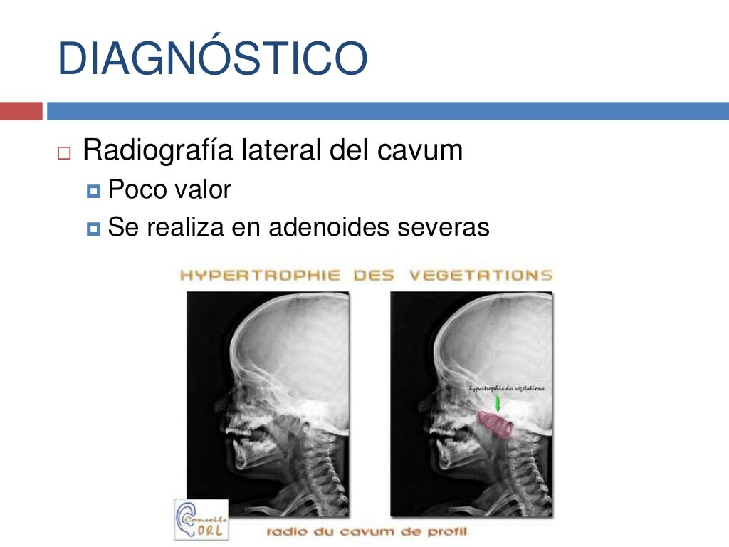 Hipertrofia de adenoides