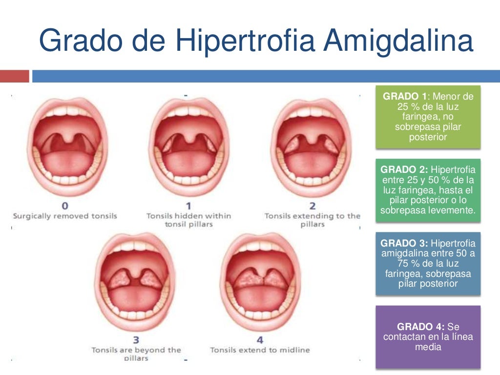 Hipertrofia de adenoides