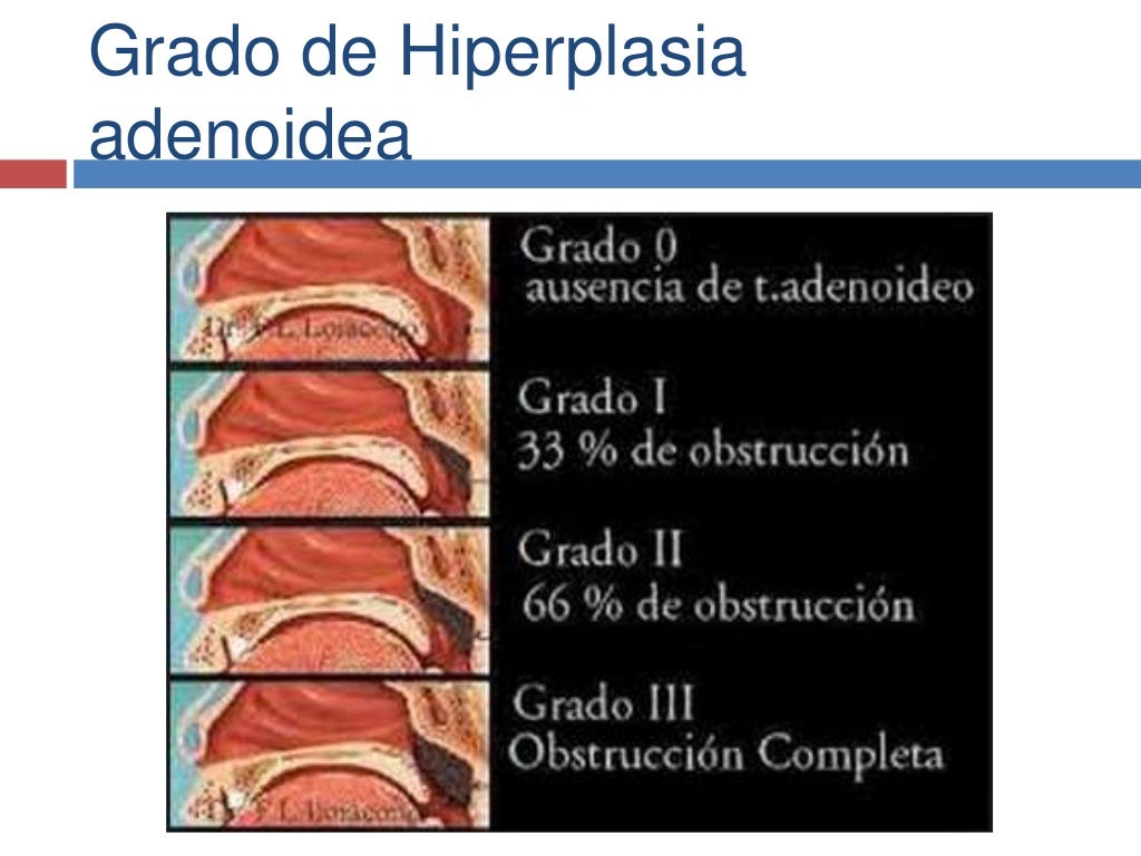Hipertrofia de adenoides