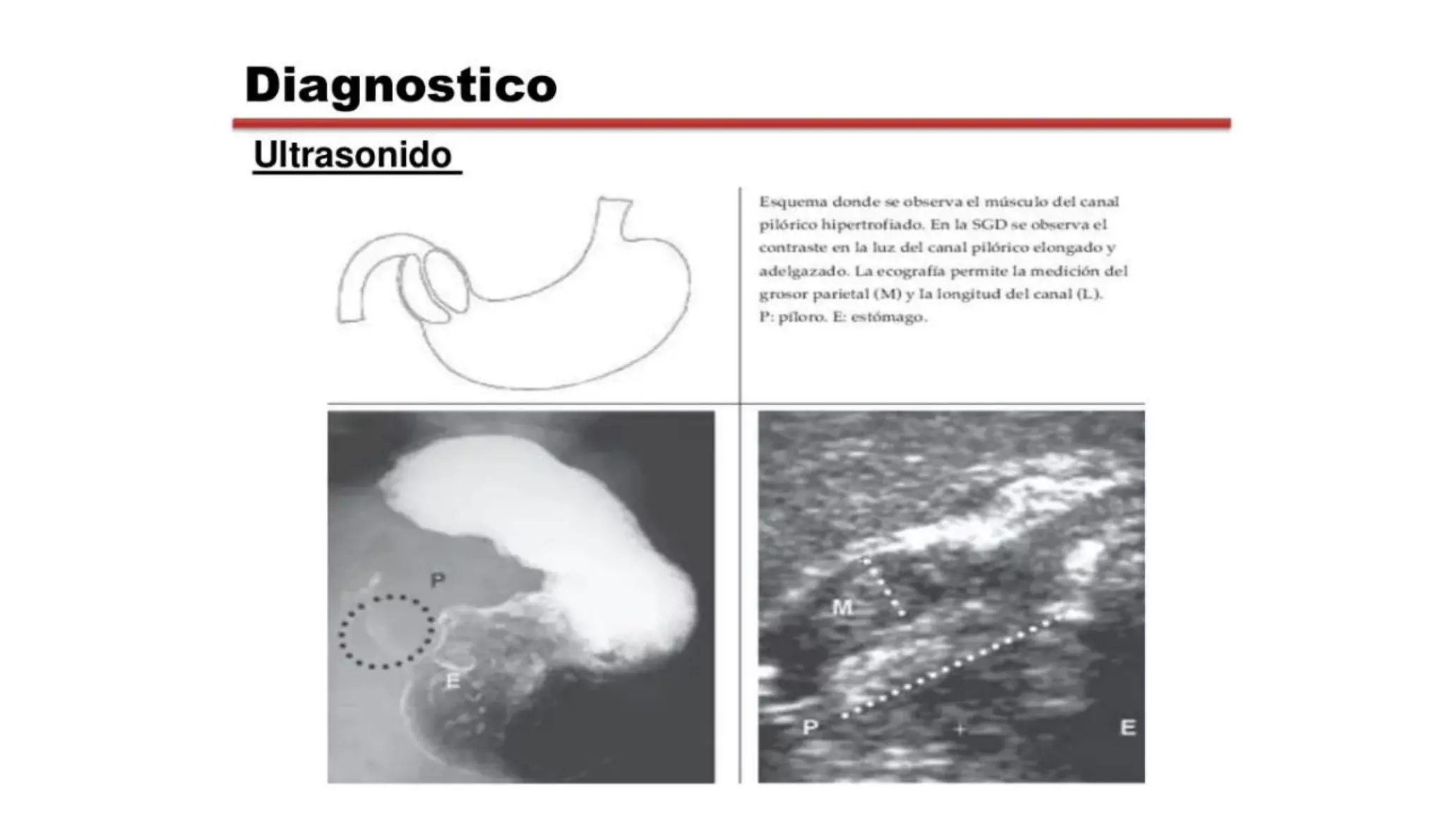 Hipertrofia del piloro | PPT