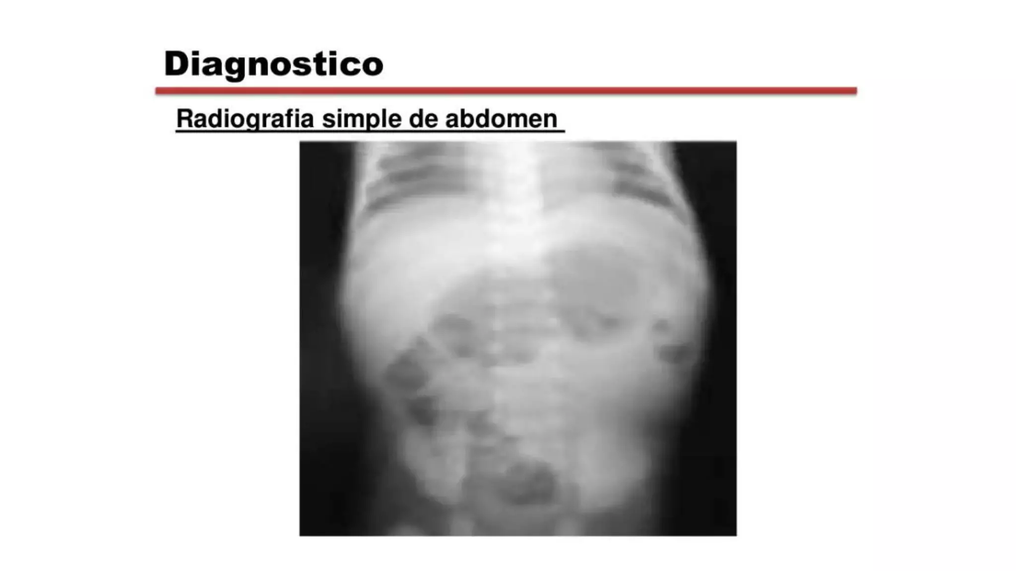 Hipertrofia del piloro | PPTX