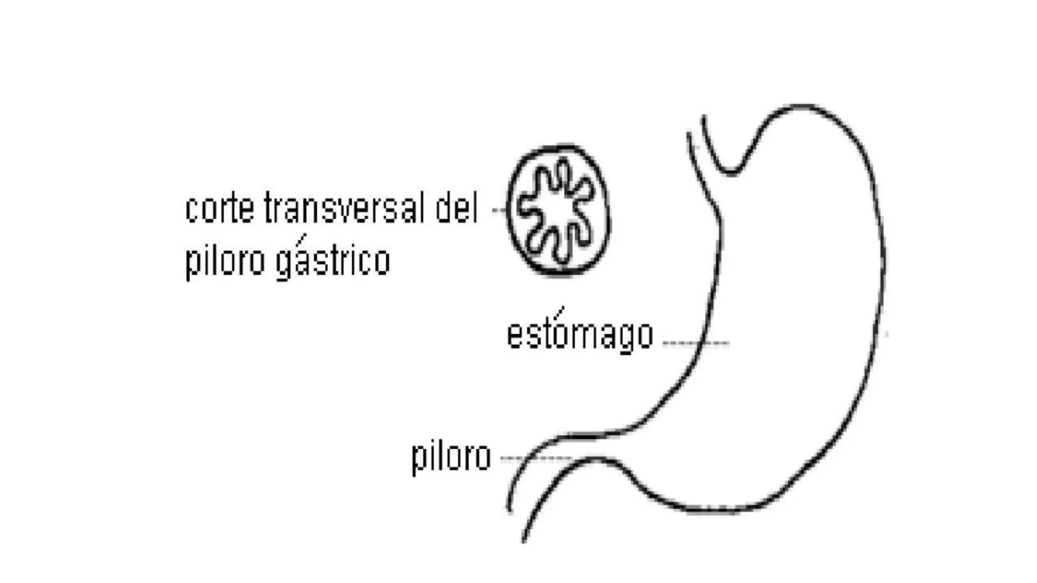 Hipertrofia del piloro | PPT