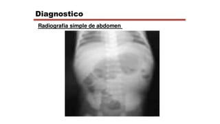 Hipertrofia del piloro | PPT