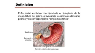 Hipertrofia del piloro | PPT