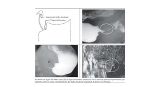 Hipertrofia del piloro | PPT