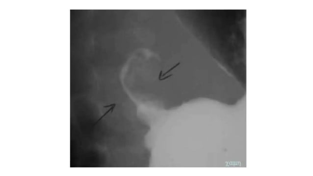 Hipertrofia del piloro | PPT