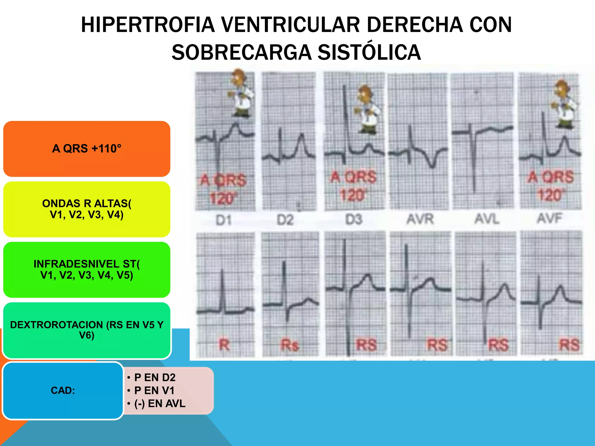 Hipertrofia ventricular electrocardiograma | PPTX