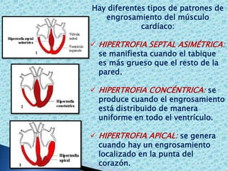 Hipertrofia Congénita del Ventrículo Izquierdo | PPT