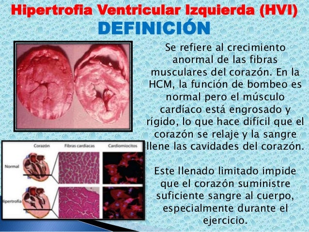 Hipertrofia Congénita del Ventrículo Izquierdo